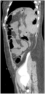 Colon Cancer with Colosplenic Fistula - MedCrave online