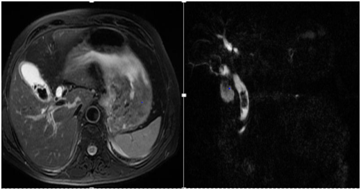 Role of magnetic resonance cholangiopancreatography in biliary ...