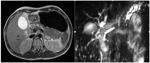 Role of magnetic resonance cholangiopancreatography in biliary ...