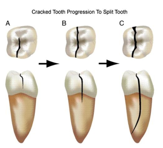 Tooth Fracturecracked Tooth Causes Diagnosis And Treatments