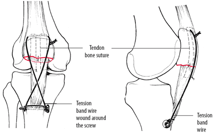 Using Ipsilateral Semitendonosus Tendon in Reconstruction of Infected ...