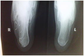 Partial Calcaneal Decortication and Vastus Lateralis Free Muscle Flap ...